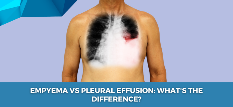 Empyema vs Pleural Effusion: What's the Difference?