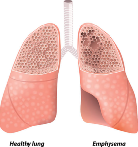 Difference Between Bronchiectasis and Emphysema | Dr. George