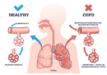 Smoke Lungs vs. Healthy Lungs | Dr. George Karimundackal